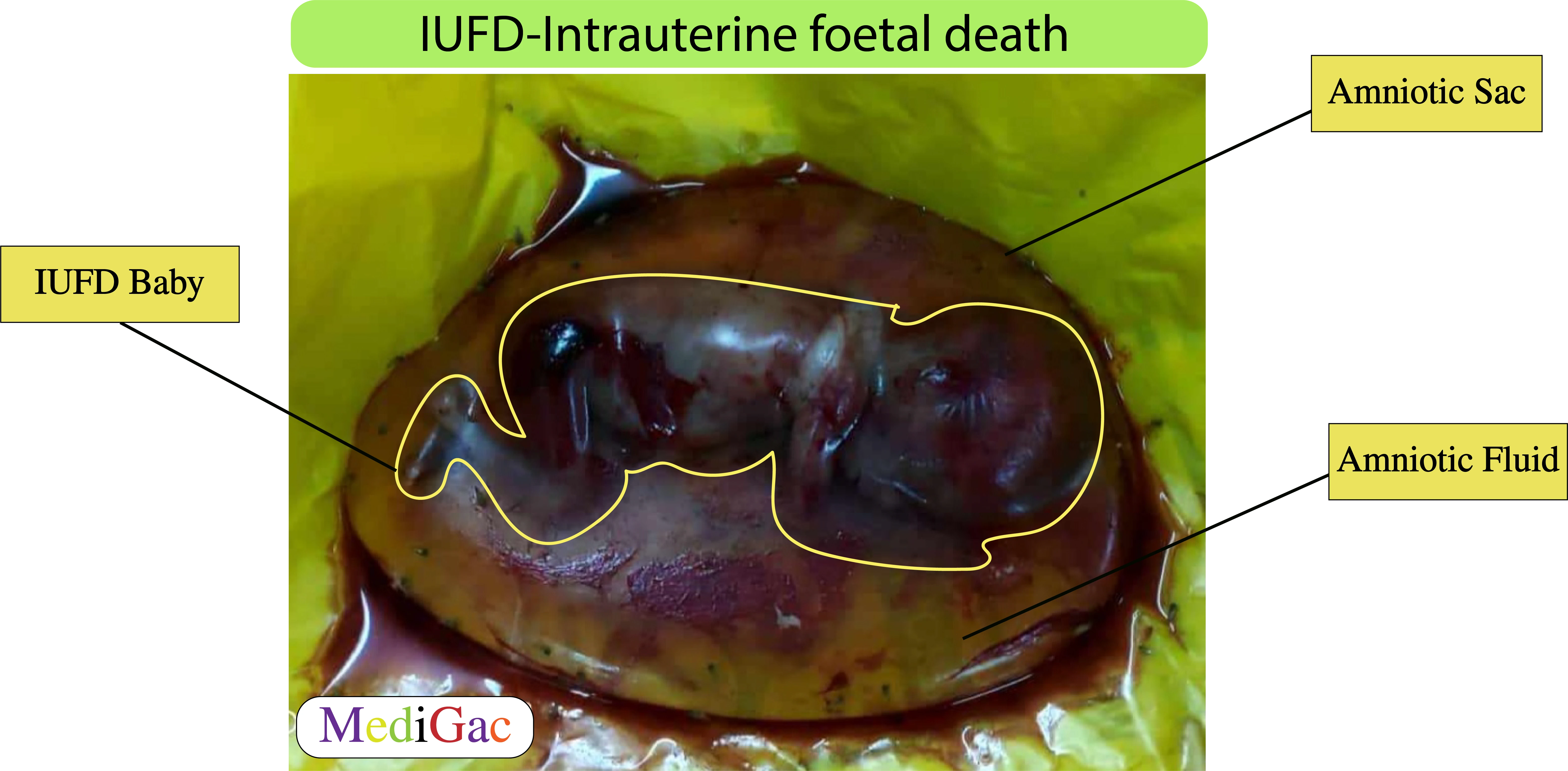 IUFD Baby – Causes, Diagnosis , Management – MediGac