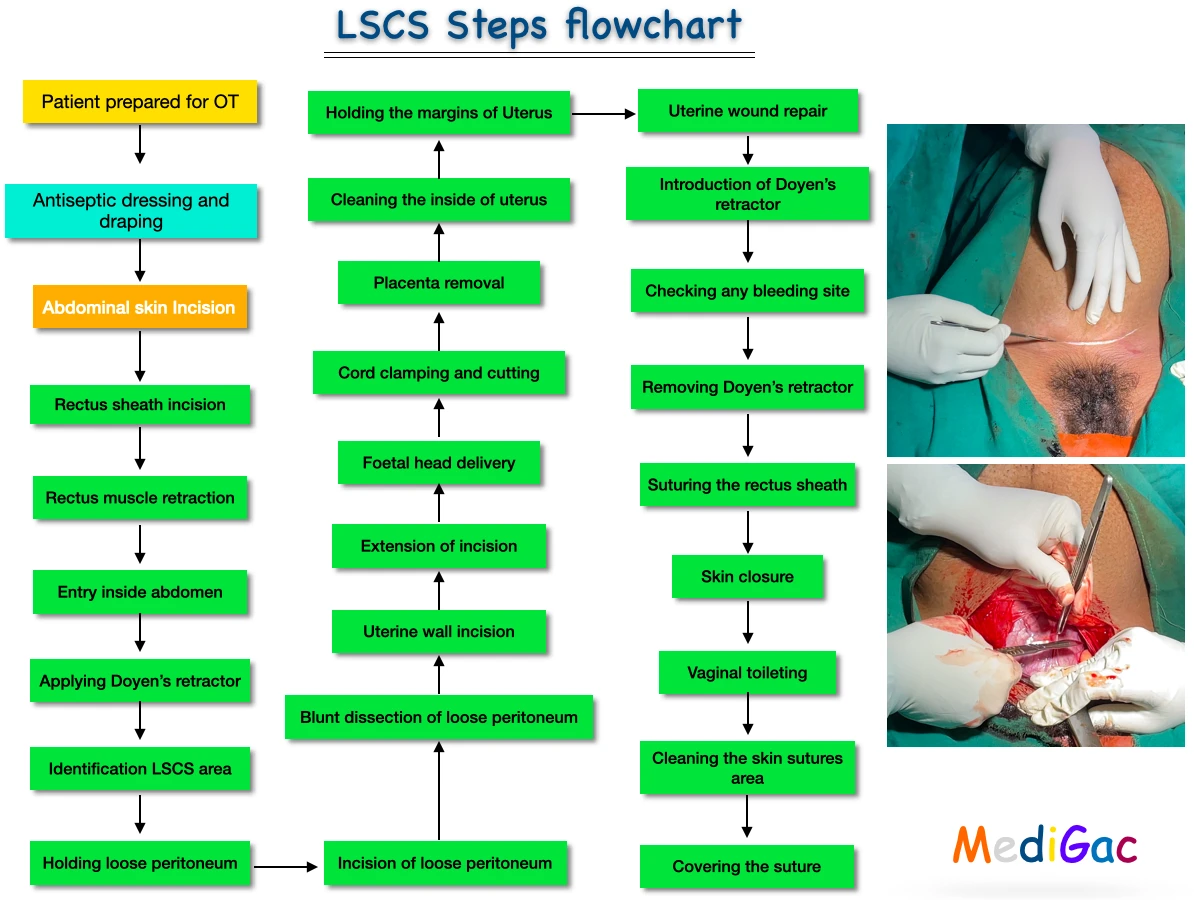 Lower uterine section caesarean section(LUCS/LSCS) – MediGac