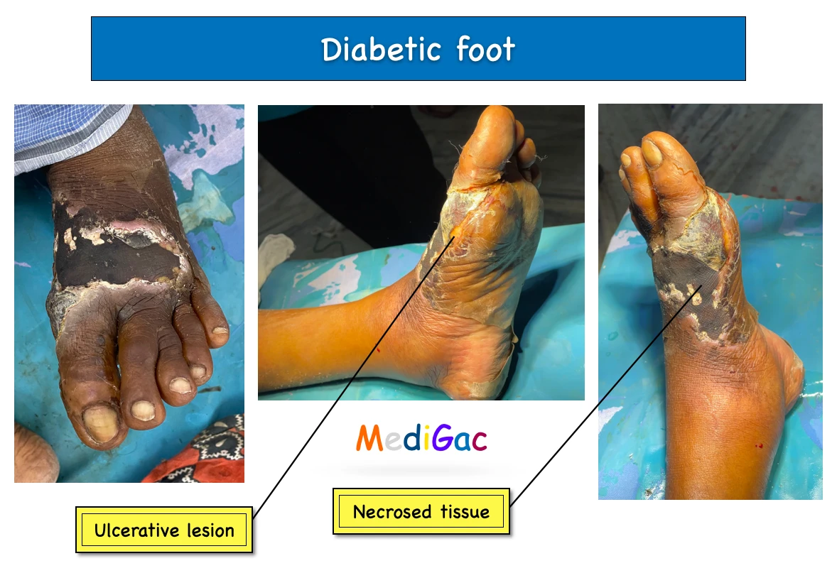 Diabetic foot – Clinical features | Investigations | Treatment – MediGac